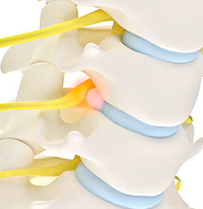 Herniated Disc (Herniated Disk) - Total Ortho Center