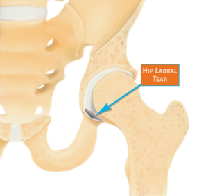 Hip Labral Tear - Total Ortho Center
