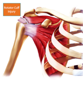 Rotator Cuff Injury | Conditions & Treatments | Total Ortho Center