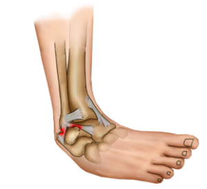 Ankle Sprain | Conditions & Treatments | Total Ortho Center