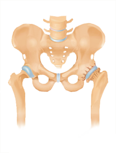 Hip Osteoarthritis | Conditions & Treatments | Total Ortho Center