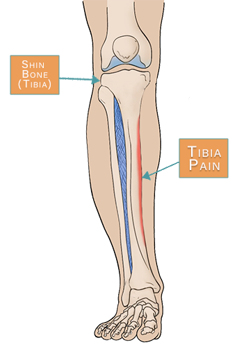 Shin Splints Total Ortho Center